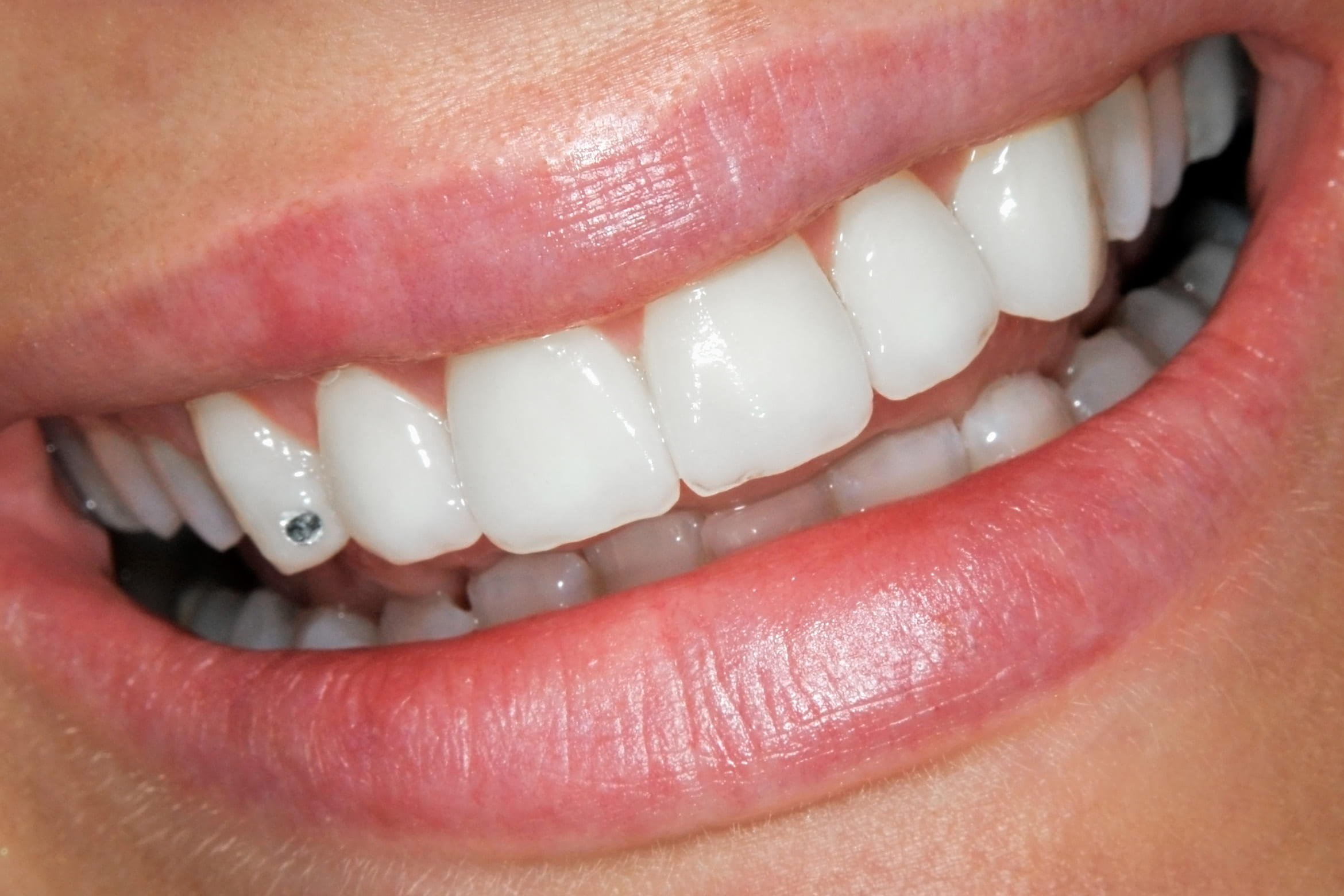 Tannsmykke - Colosseum Tannlege